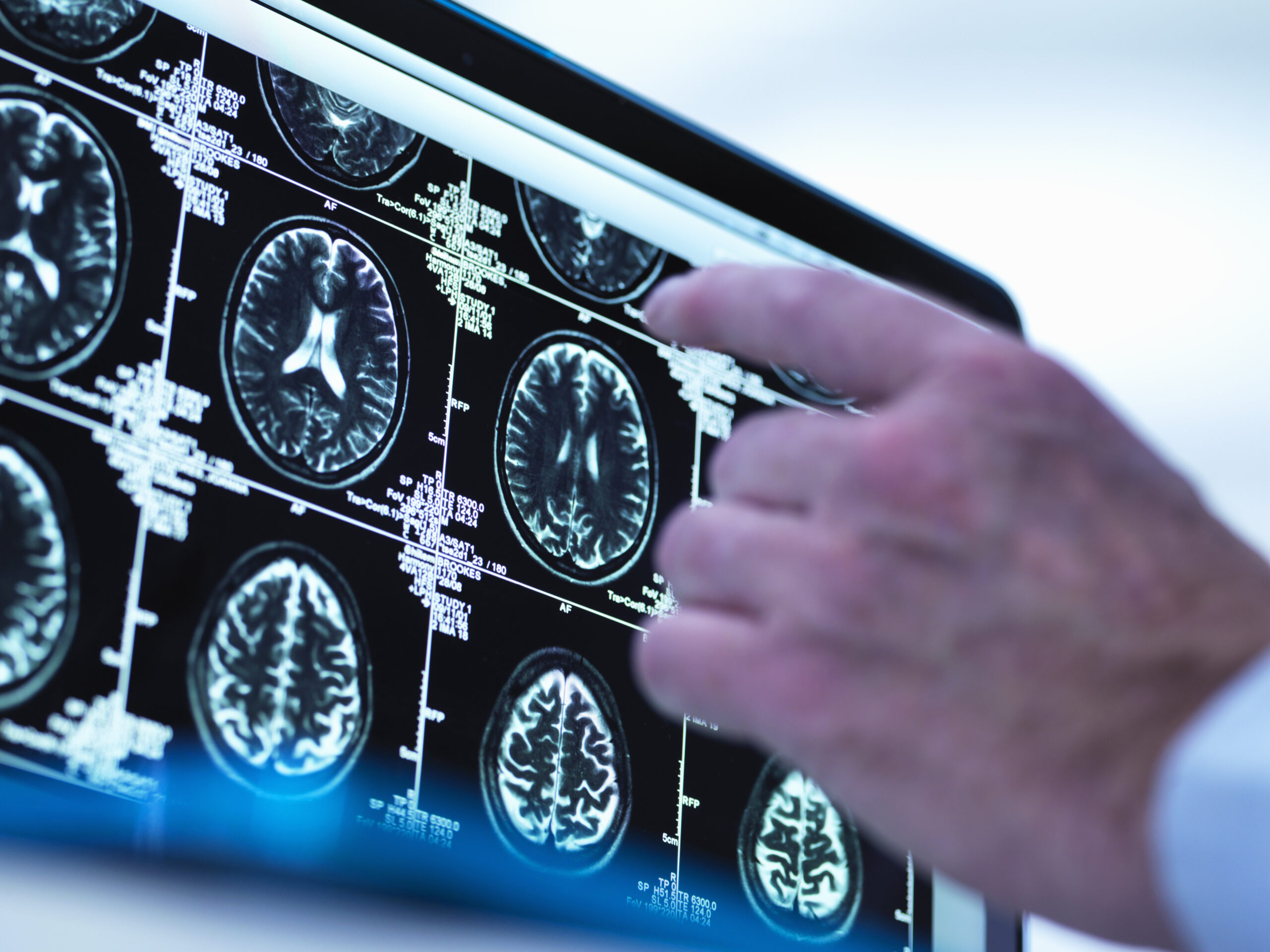 Vidas paralizadas: el drama invisible de la esclerosis múltiple en Perú ...